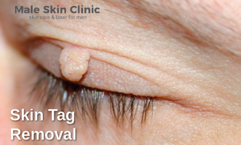 Skin Tags - Birmingham Male Skin Clinic